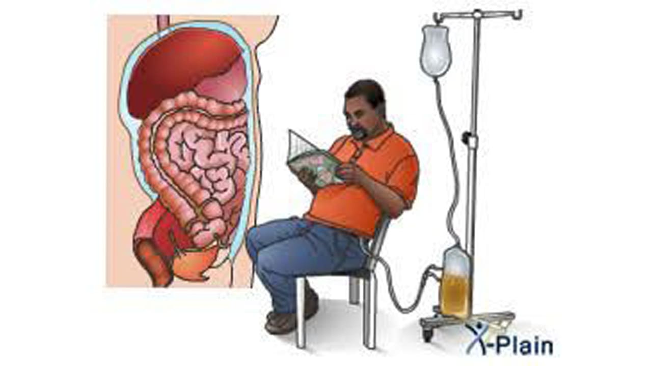 Adecuación de Hemodiálisis